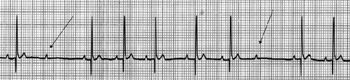 ECG interpretation by Charlotte Pace - British Veterinary Nursing ...
