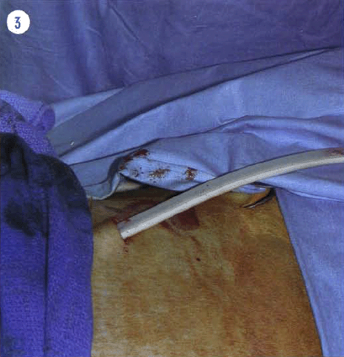 Thoracostomy tube placement, drainage and management in dogs and cats ...