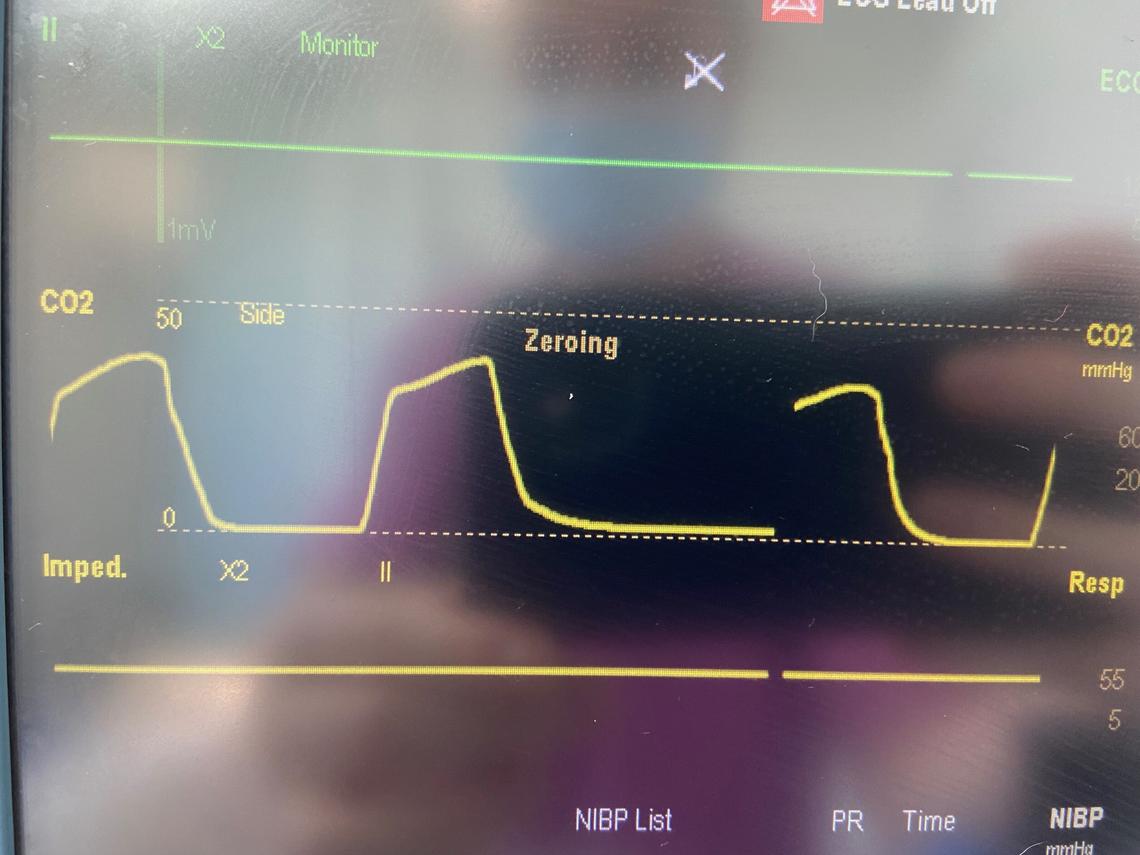 Capnography: the best anaesthetic monitoring tool? by Anarosa Wallace ...
