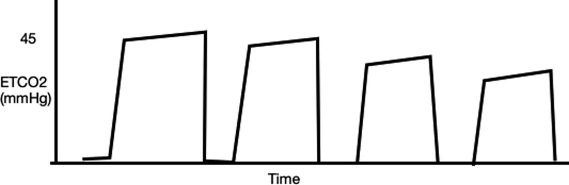 Capnography: the best anaesthetic monitoring tool? by Anarosa Wallace ...