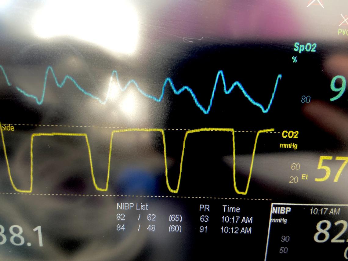 Capnography: the best anaesthetic monitoring tool? by Anarosa Wallace ...
